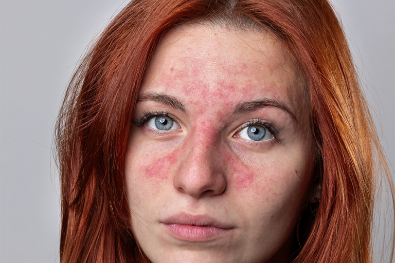 Rosacea or Regular Flush? Here’s How to Tell - Dermatology Affiliates