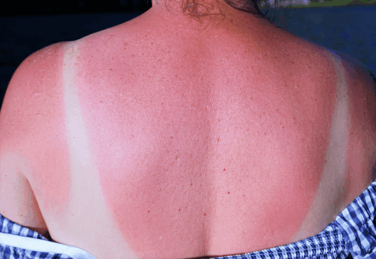 What To Do For Severe Sunburns - Dermatology Affiliates